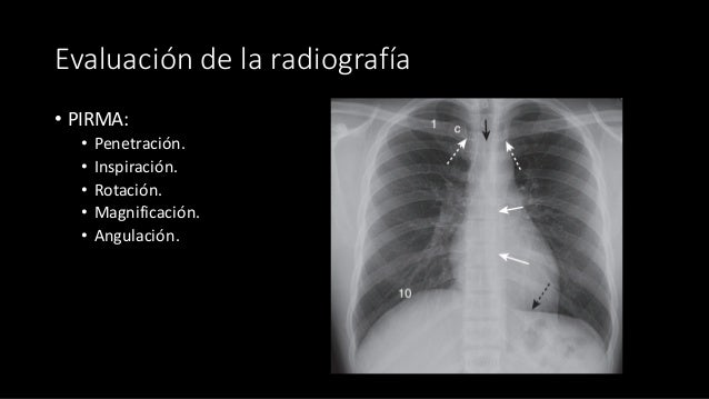 RAYOS X DE TORAX (INTRODUCCIÓN) FÍSICA Y POSICIONES