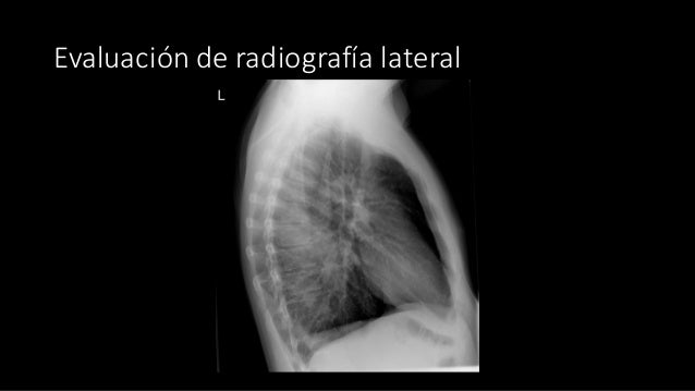 RAYOS X DE TORAX (INTRODUCCIÓN) FÍSICA Y POSICIONES
