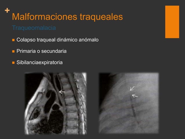 Malformaciones congénitas del tórax | PPTX