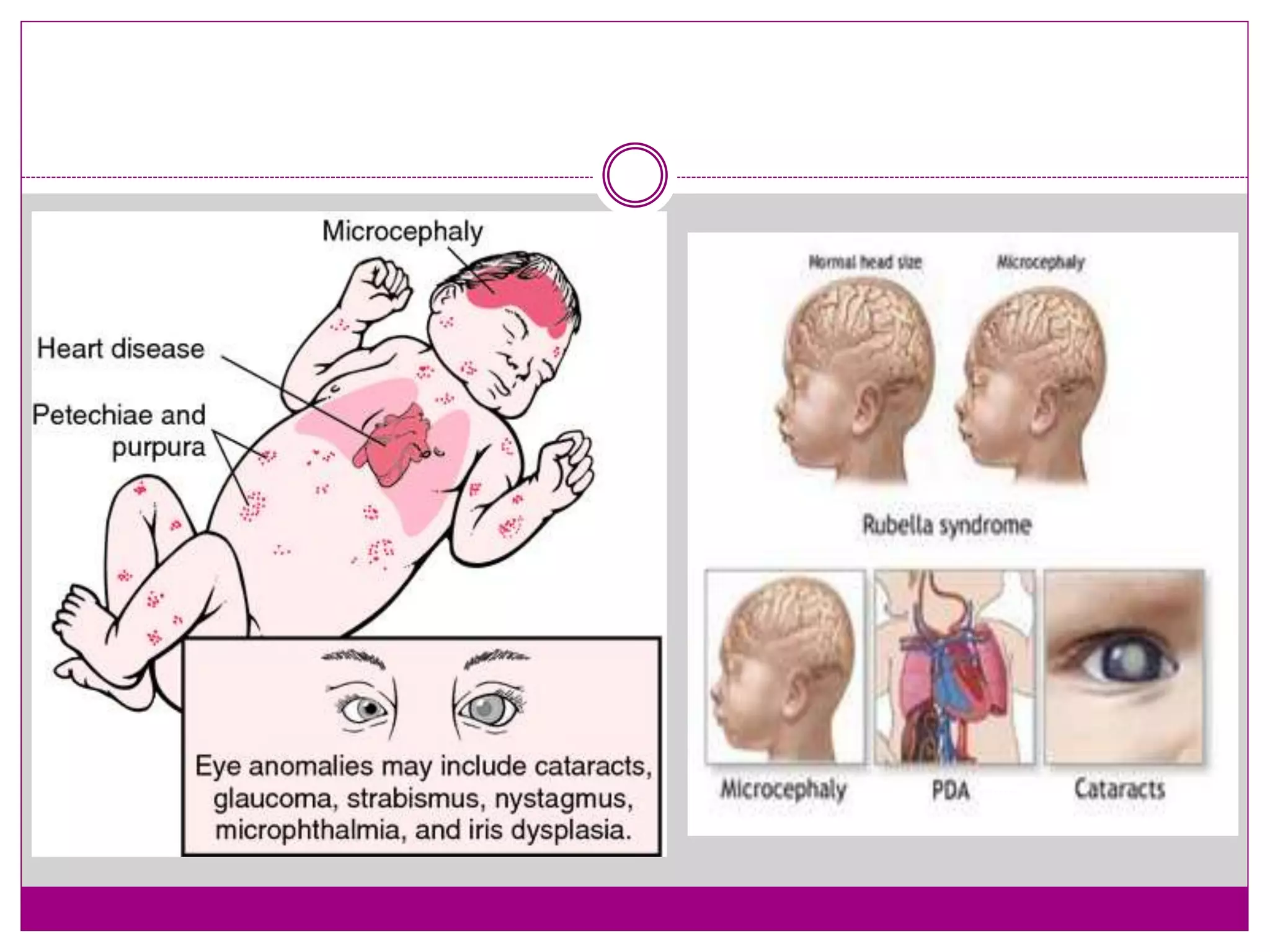 Torch infection in pregnancy | PPTX