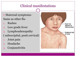 Torch infection in pregnancy | PPTX