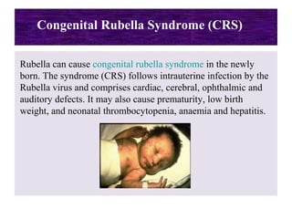 Torch infection | PPT