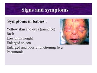 Torch infection | PPT