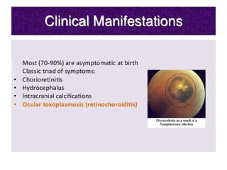 Torch infection | PPT