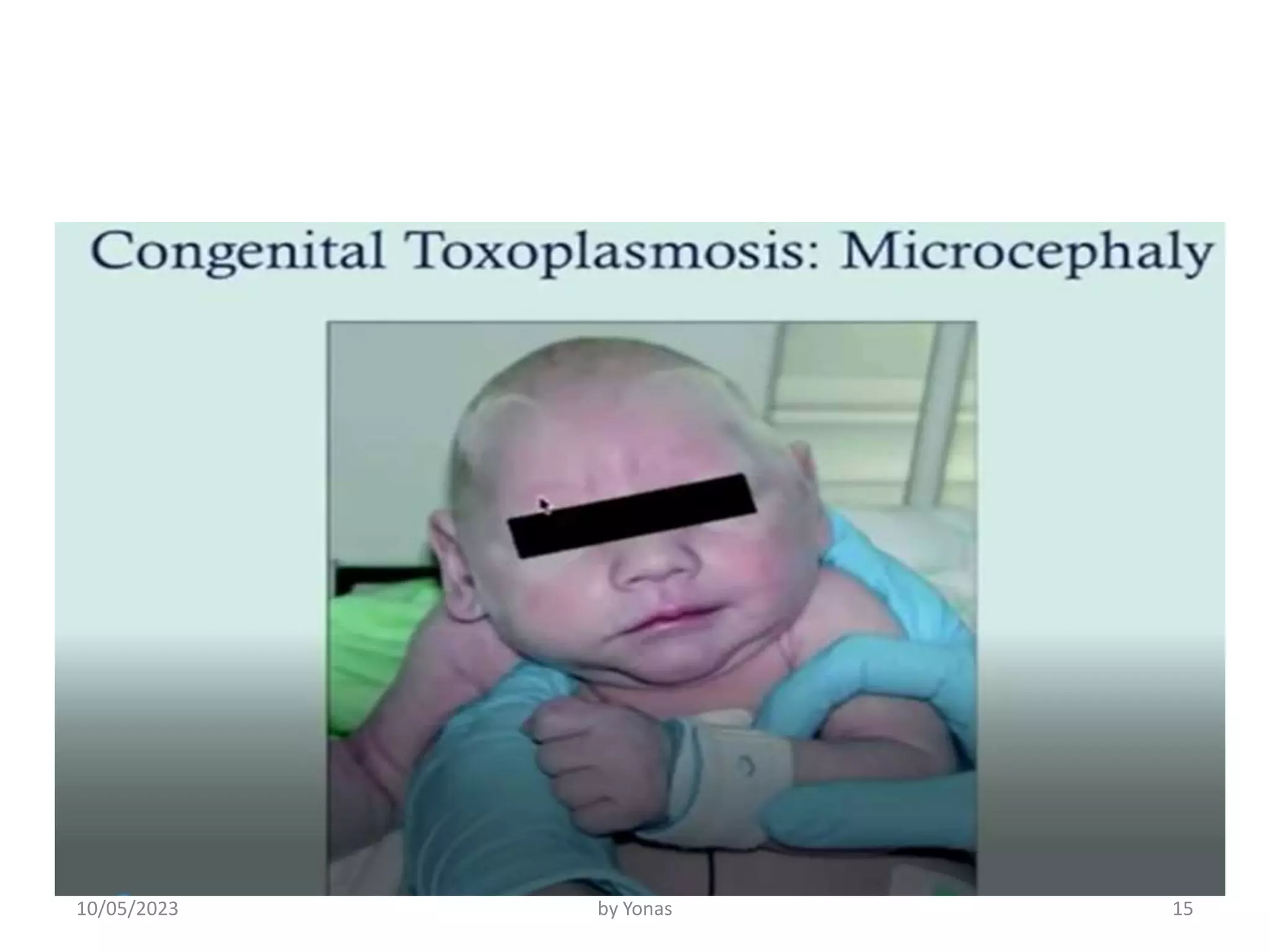 TORCH Infections.pptx