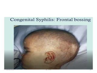 Frontal Bossing Syphilis