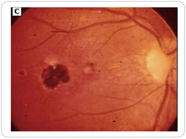 TORCH Infection in neonate (newborn) | PPTX | Pregnancy | Reproductive ...