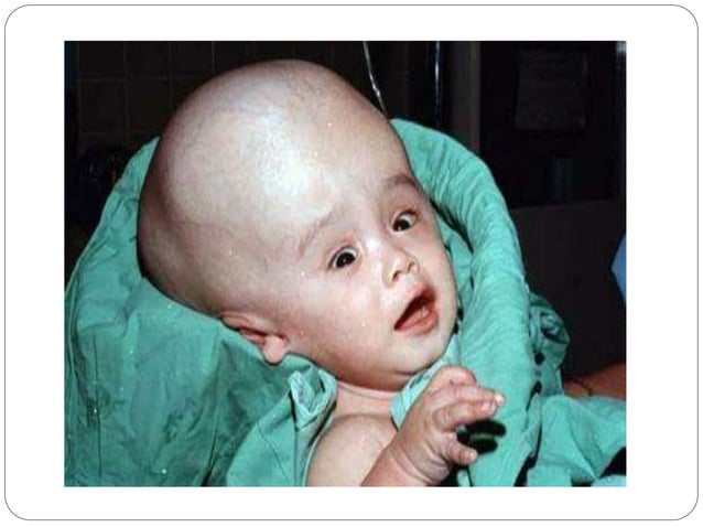 TORCH Infection in neonate (newborn) | PPTX | Pregnancy | Reproductive ...