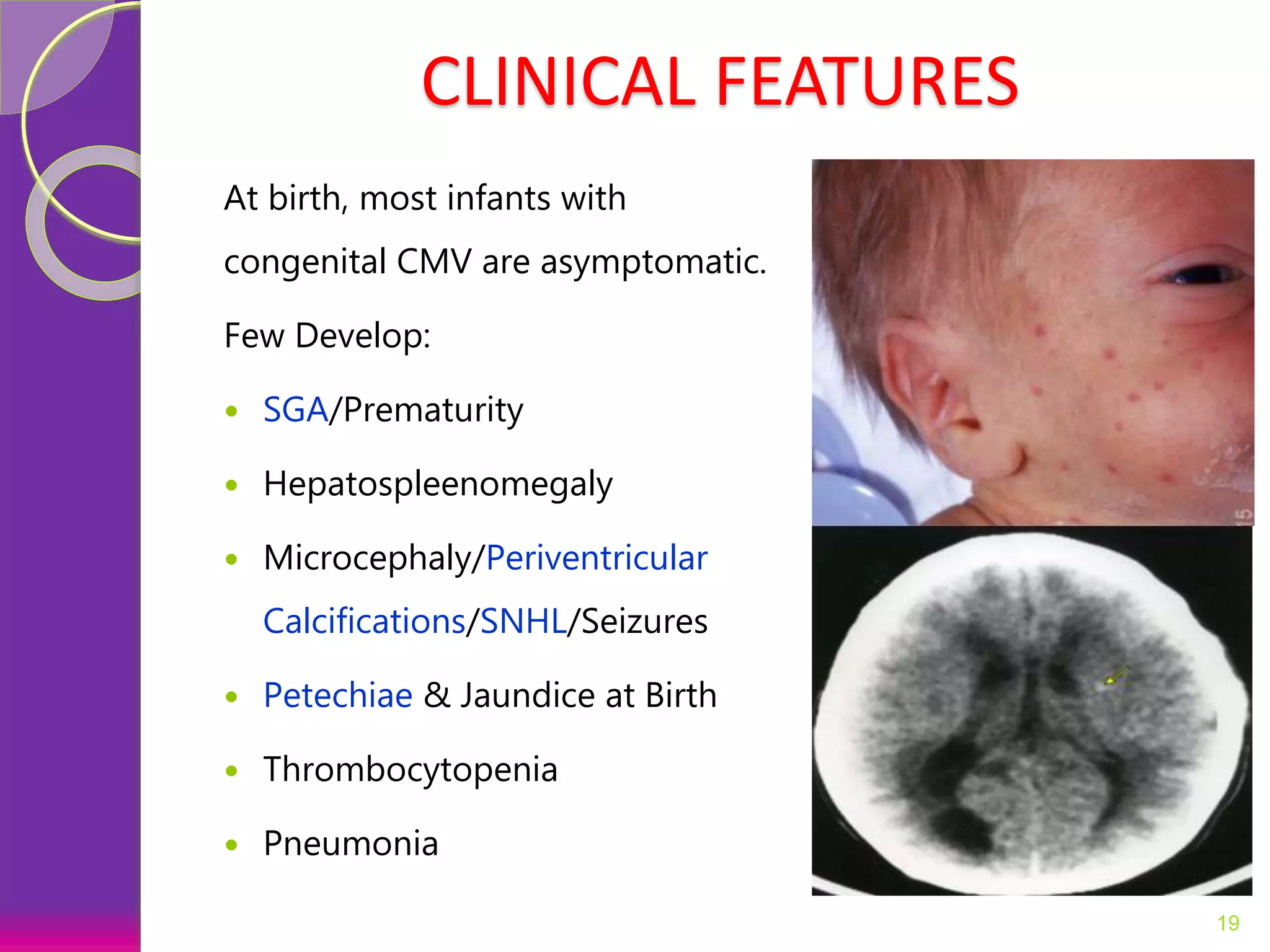 TORCH INFECTION | PPTX