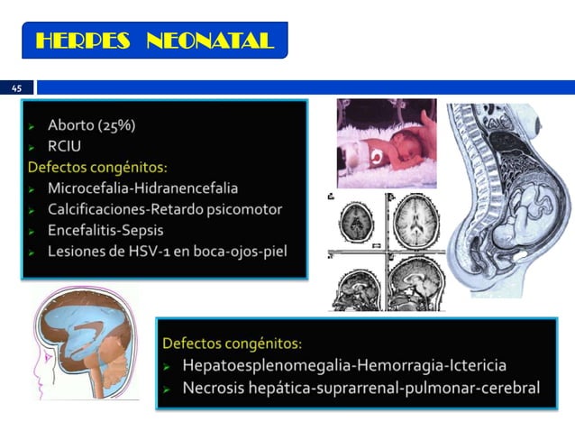 Torch y embarazo | PPTX