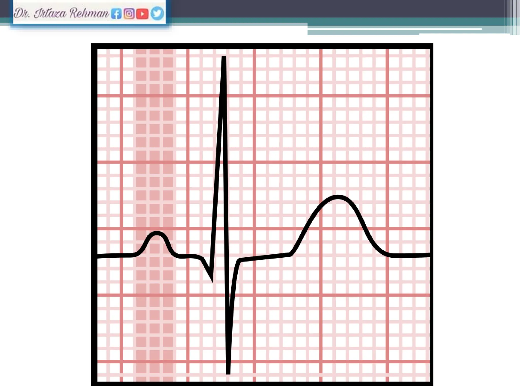 To record Normal Human ECG by Using Bipolar.pptx
