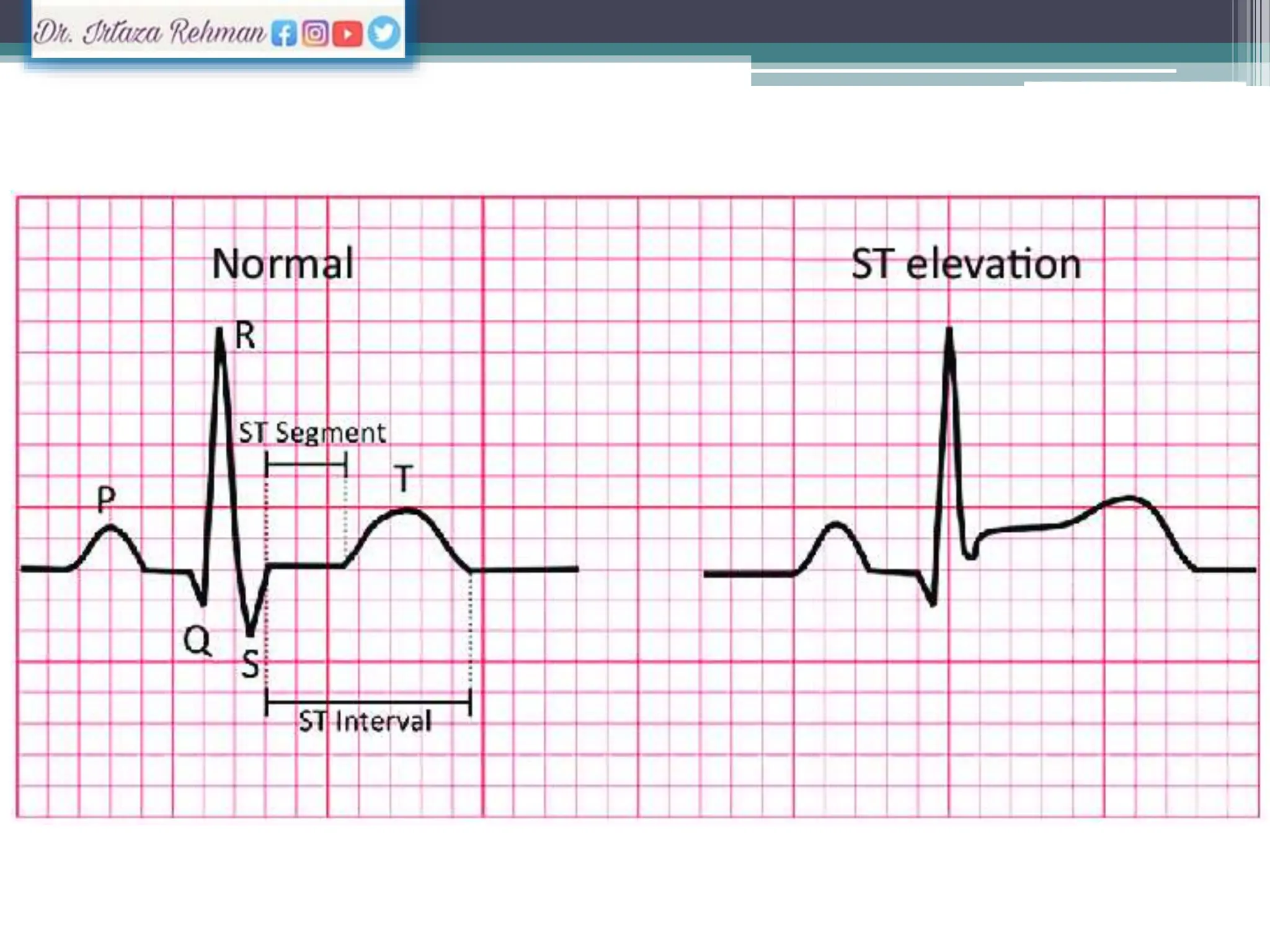 To record Normal Human ECG by Using Bipolar.pptx