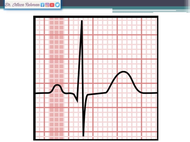 To record Normal Human ECG by Using Bipolar.pptx | Heart and ...