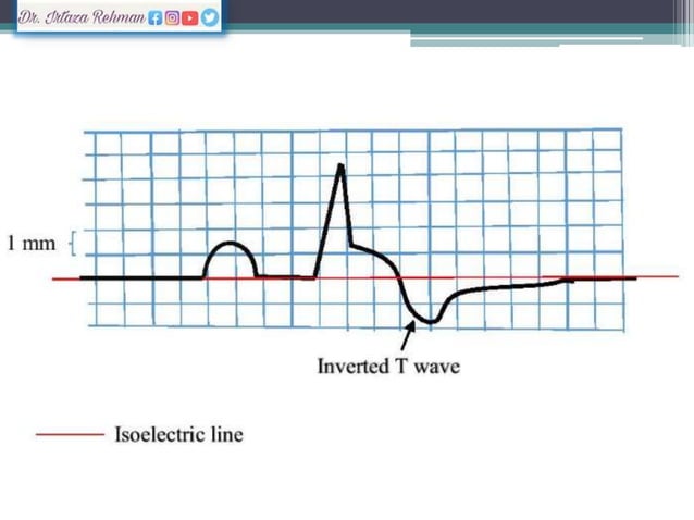To record Normal Human ECG by Using Bipolar.pptx | Heart and ...
