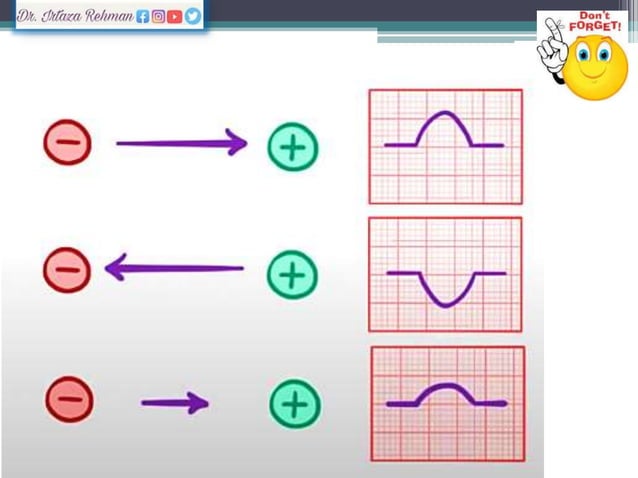 To record Normal Human ECG by Using Bipolar.pptx | Heart and ...