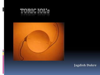 Toric iol | PPTX