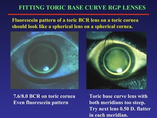 Toric rgp fit | PPT