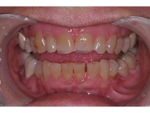 Functional and Esthetic Restoration of the Worn Dentition | PPT