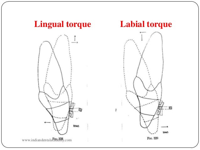 Torque /certified fixed orthodontic courses by Indian dental acade…