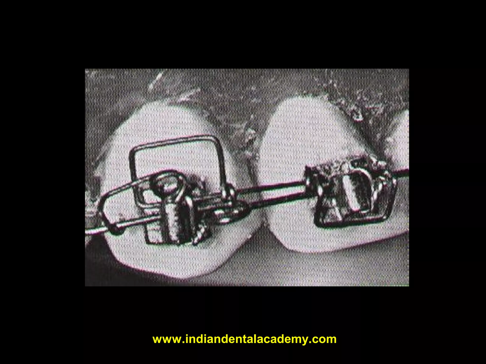 Torquing in orthodontics /certified fixed orthodontic courses by Indian dental academy | PPT
