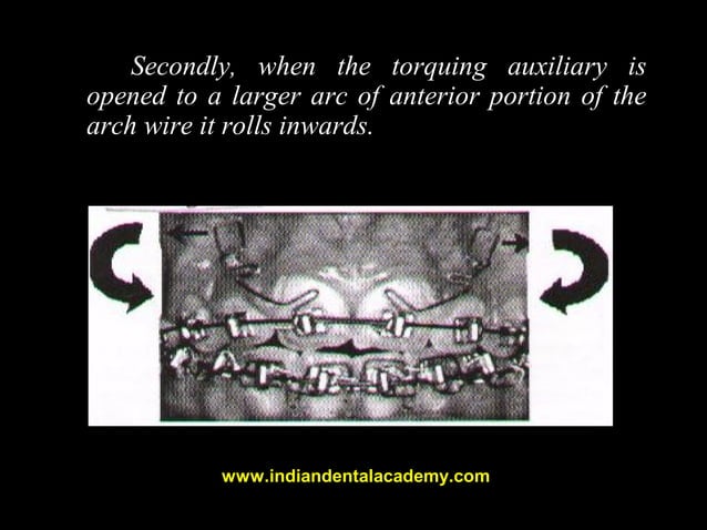 Torquing in orthodontics /certified fixed orthodontic courses by Indian dental academy | PPT