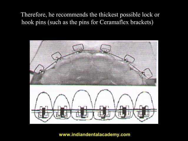 Torquing in orthodontics /certified fixed orthodontic courses by Indian dental academy | PPT