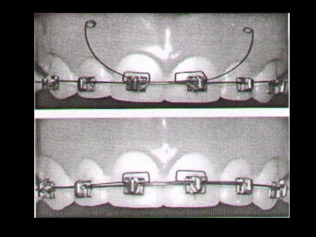 Torquing in orthodontics /certified fixed orthodontic courses by Indian dental academy | PPT