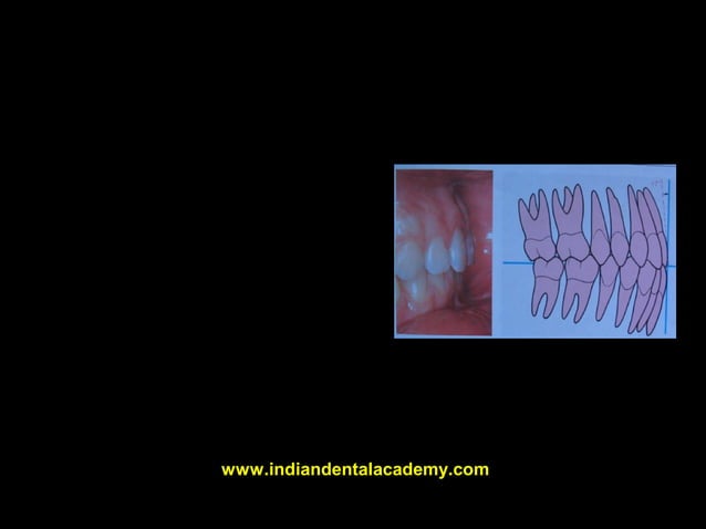Torquing in orthodontics /certified fixed orthodontic courses by Indian dental academy | PPT