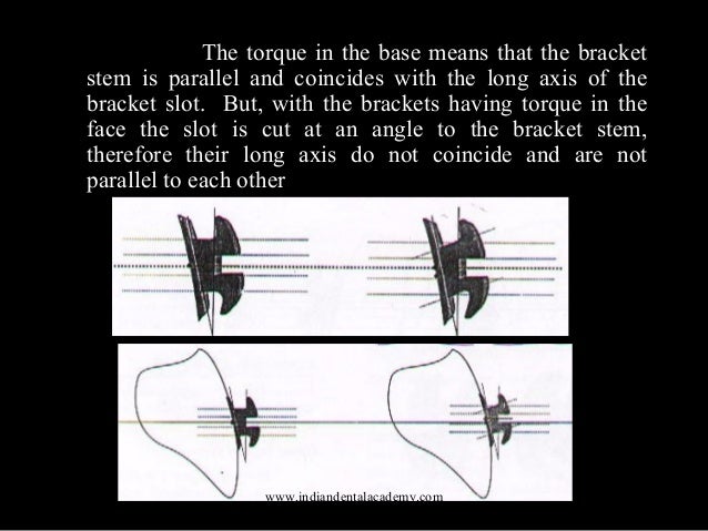 Torque and its_application /certified fixed orthodontic courses by