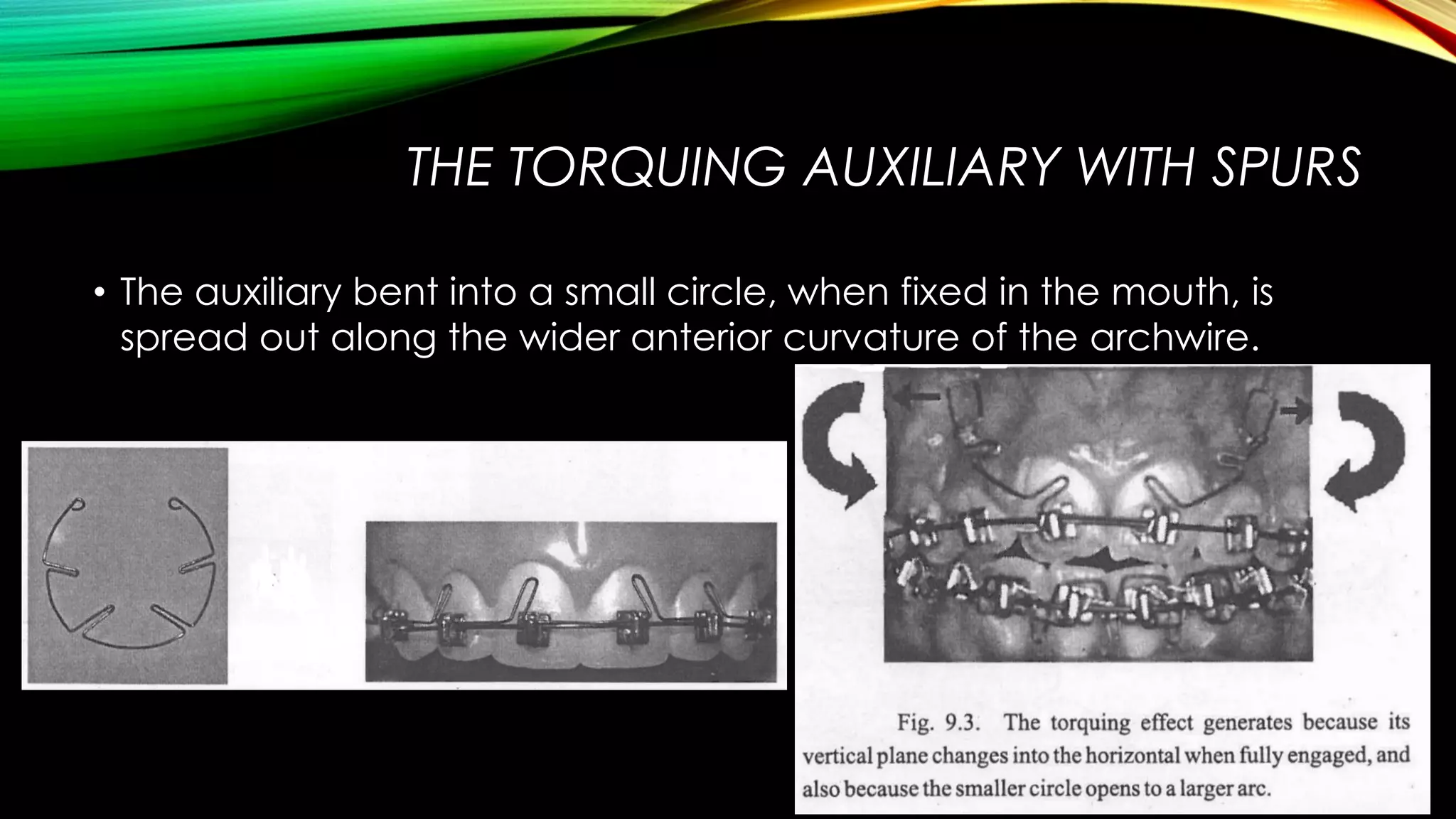 The Root Torqueing Auxiliaries in Orthodontics | PDF