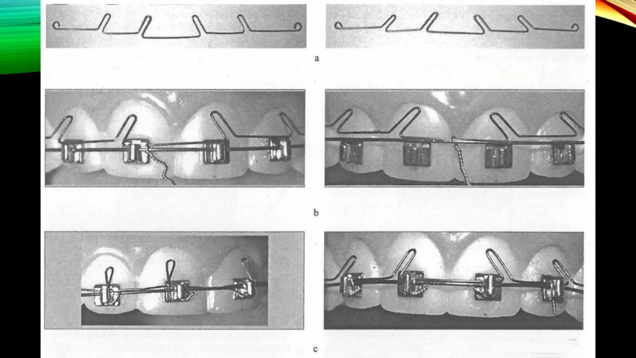 The Root Torqueing Auxiliaries in Orthodontics | PDF