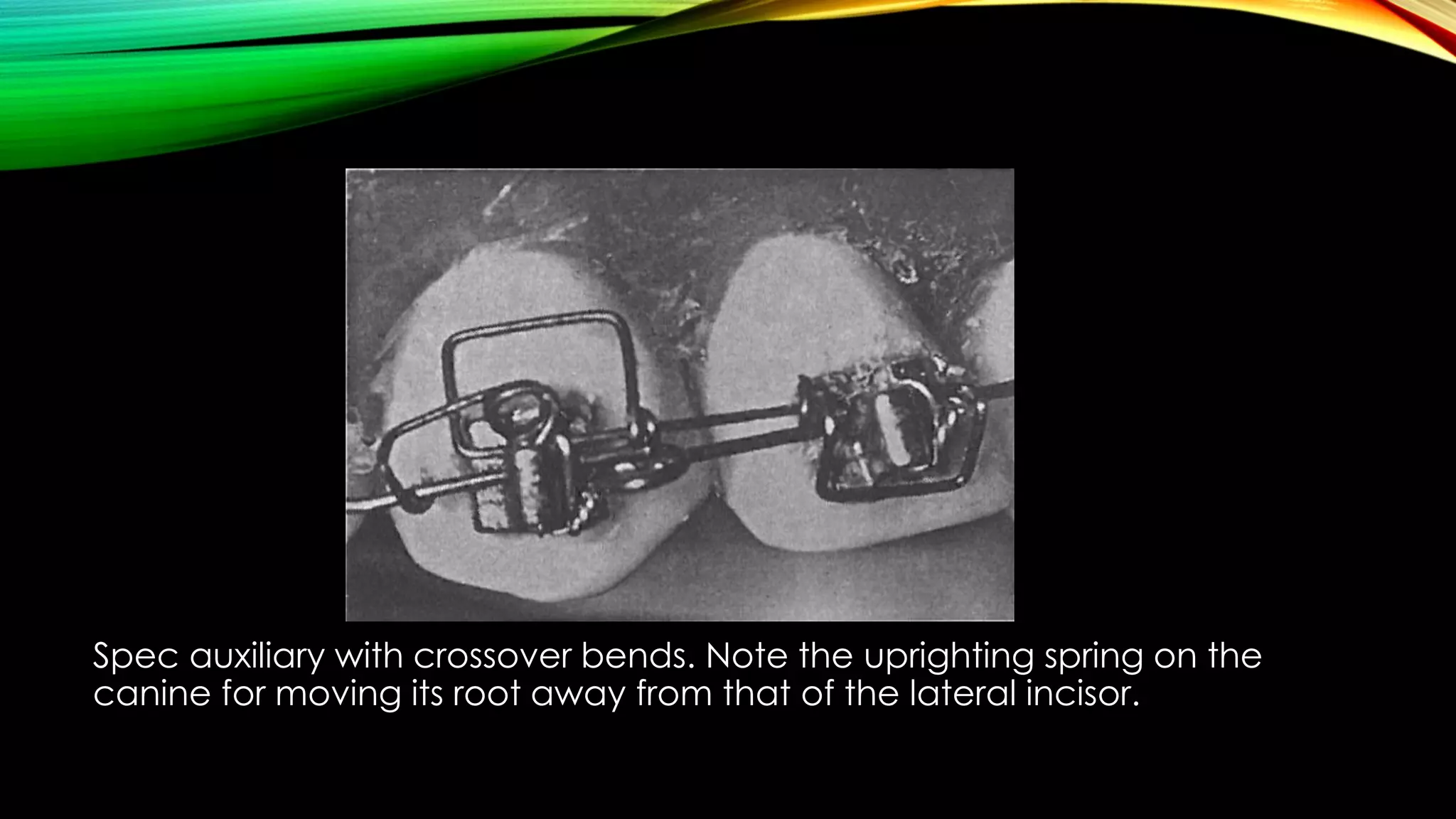 The Root Torqueing Auxiliaries in Orthodontics | PDF