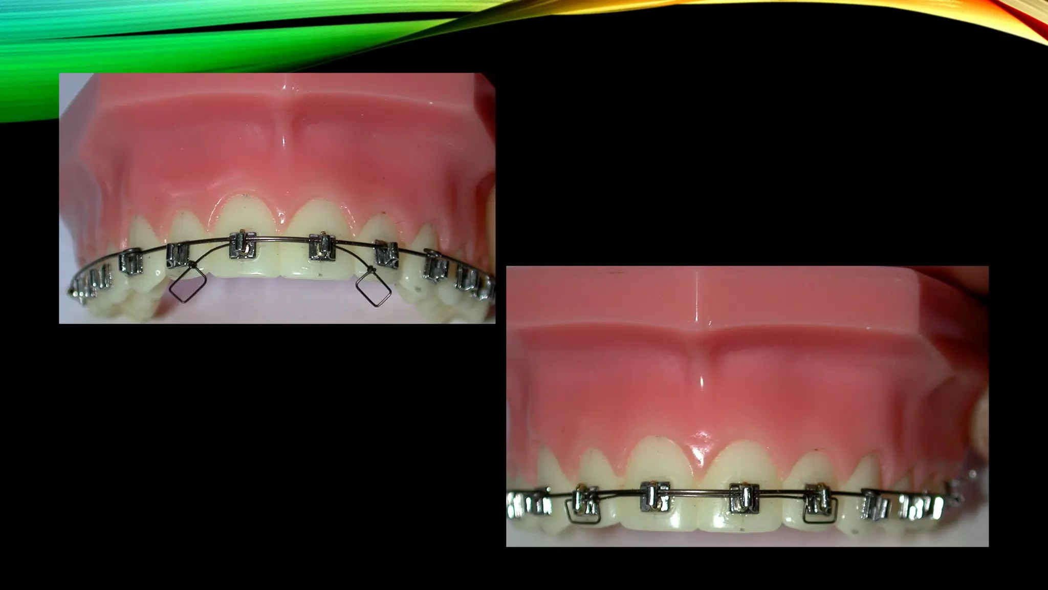 The Root Torqueing Auxiliaries in Orthodontics | PDF