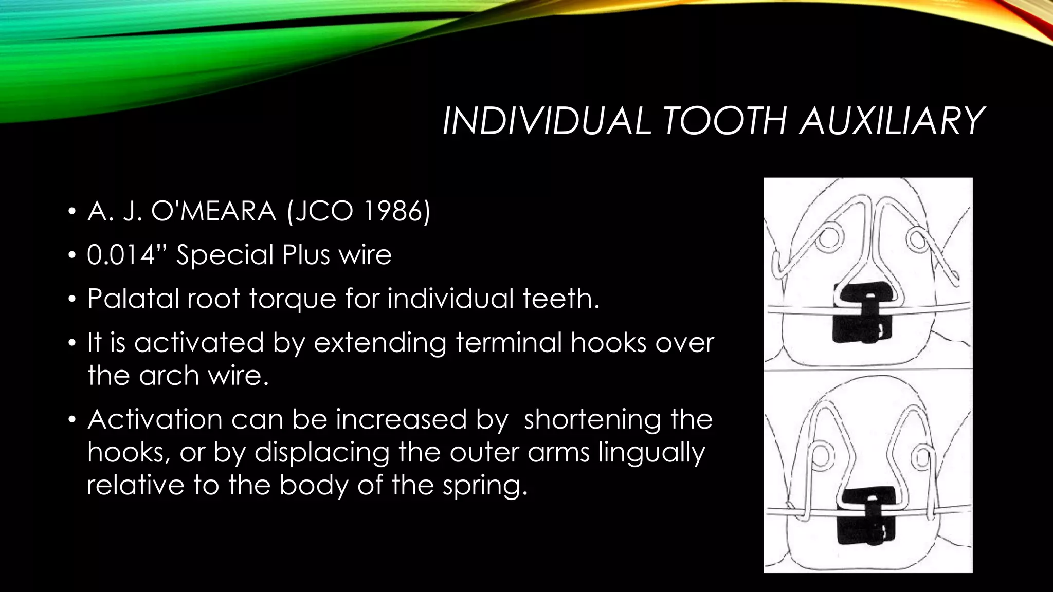 The Root Torqueing Auxiliaries in Orthodontics | PDF