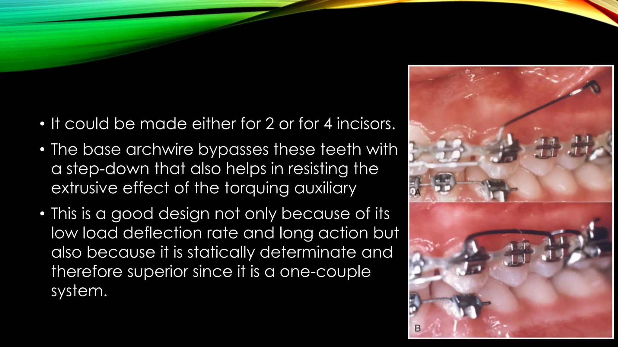 The Root Torqueing Auxiliaries in Orthodontics | PDF