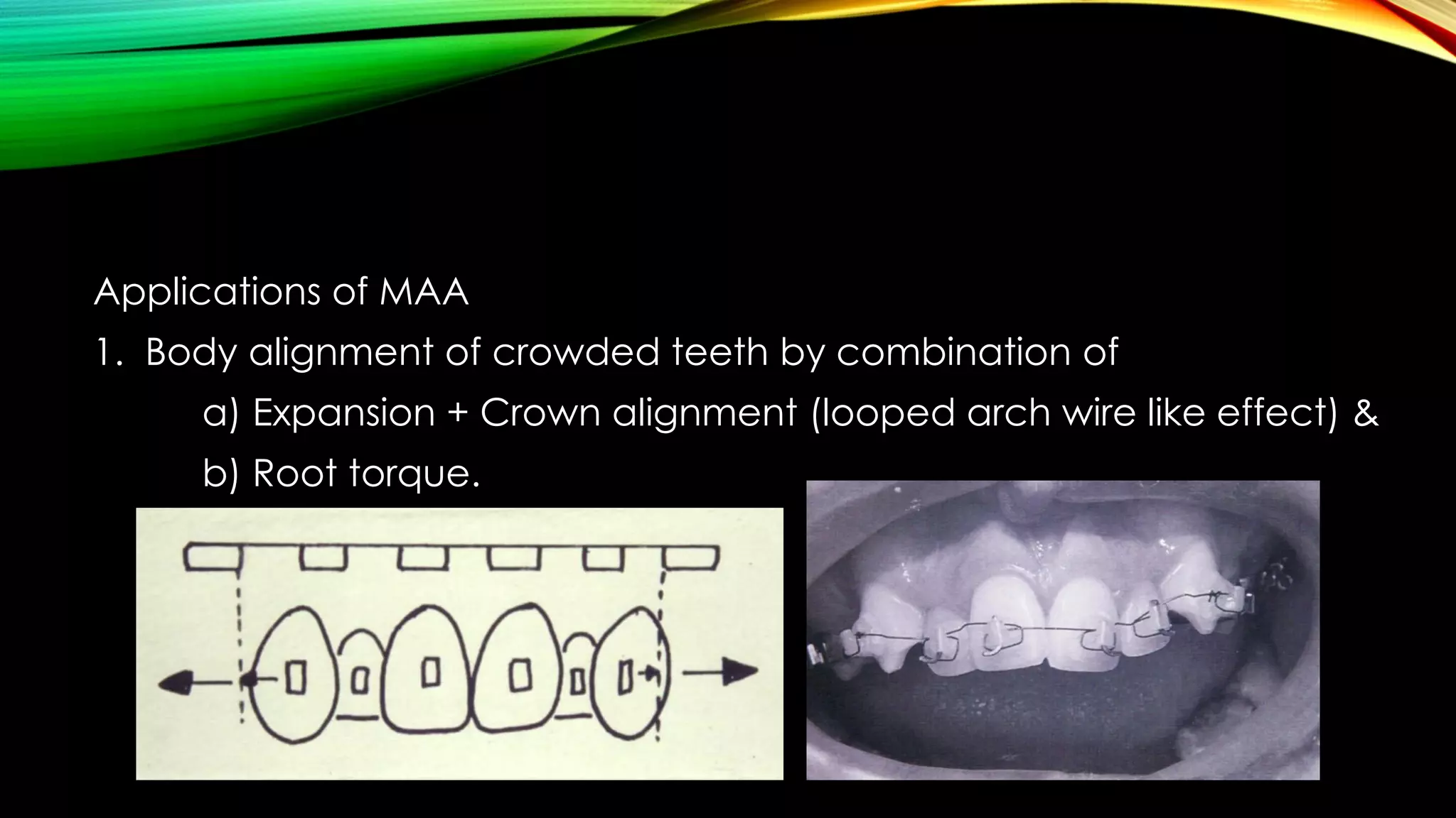 The Root Torqueing Auxiliaries in Orthodontics | PDF