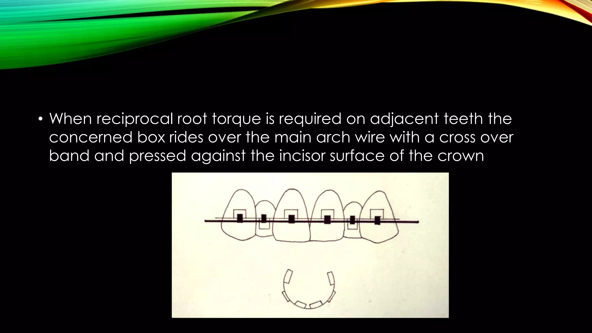 The Root Torqueing Auxiliaries in Orthodontics | PDF