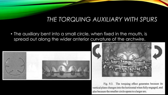 The Root Torqueing Auxiliaries in Orthodontics | PDF | Oral care ...