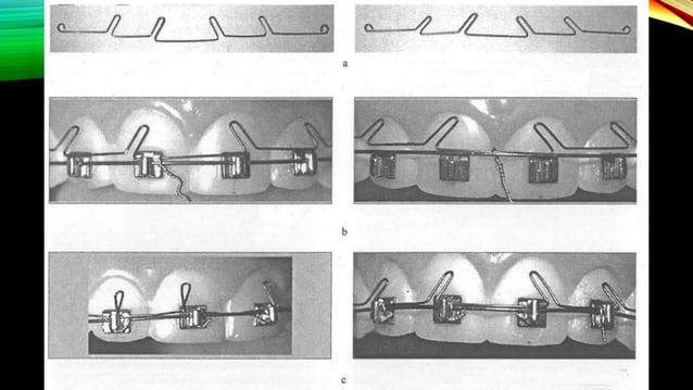 The Root Torqueing Auxiliaries in Orthodontics | PDF | Oral care ...