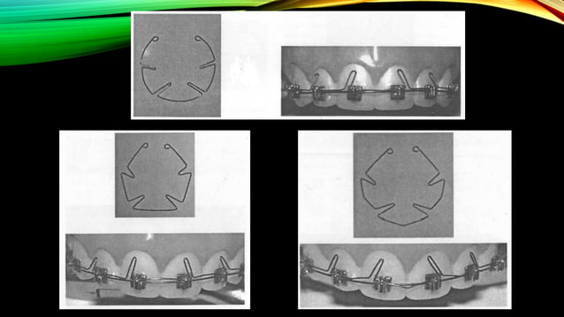 The Root Torqueing Auxiliaries in Orthodontics | PDF | Oral care ...
