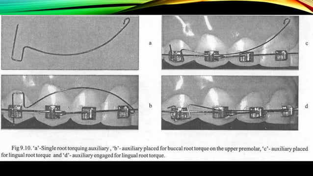 The Root Torqueing Auxiliaries in Orthodontics | PDF | Oral care ...