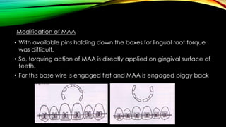 The Root Torqueing Auxiliaries in Orthodontics | PDF