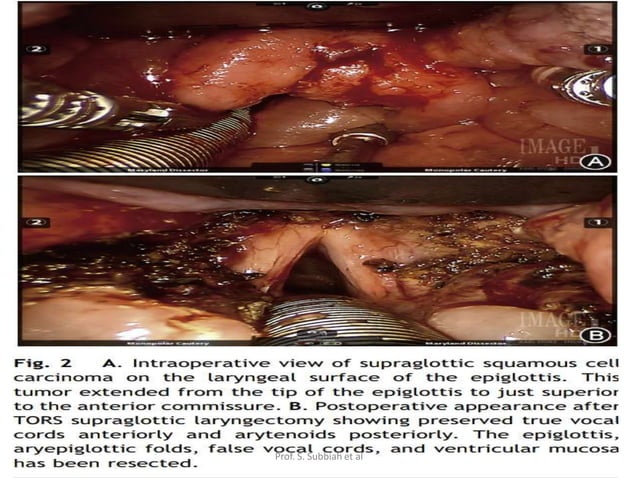 TORS.pptx | Ear, Nose and Throat Conditions | Diseases and Conditions