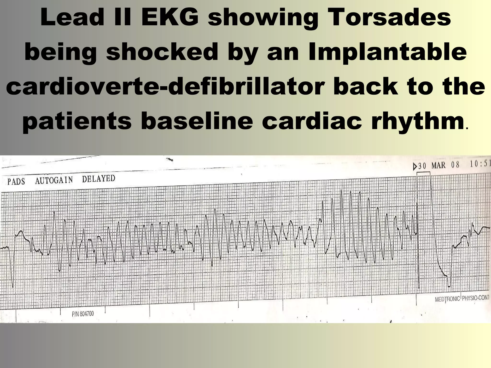 Torsades De Pointes | PPT