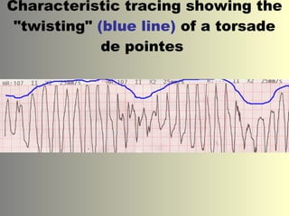 Torsades De Pointes | PPT