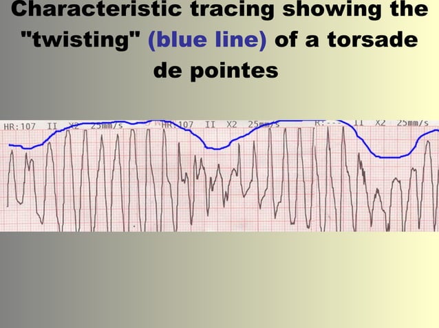 Torsades De Pointes | PPT