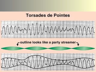 Torsades De Pointes | PPT