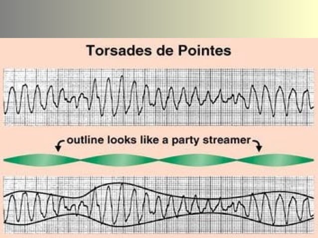Torsades De Pointes | PPT