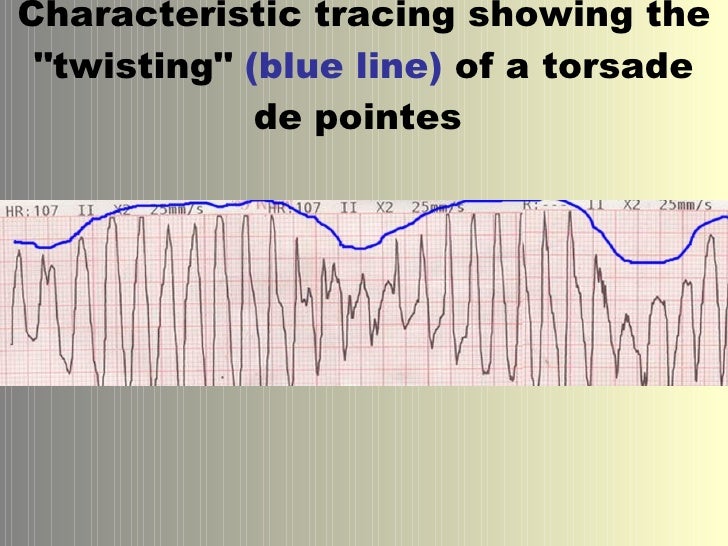 Torsades De Pointes