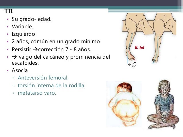 Torsión tibial